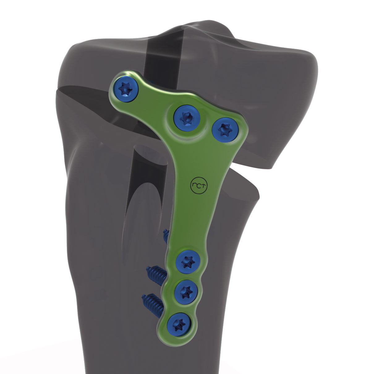 Activmotion S: HTO medial öffnend + ACL : Heintel