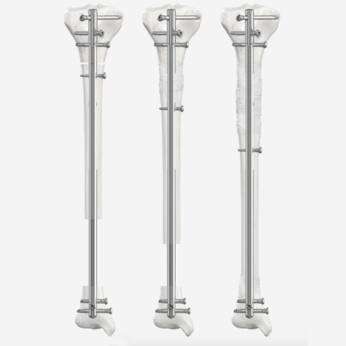 Precice Bone Transport : Heintel